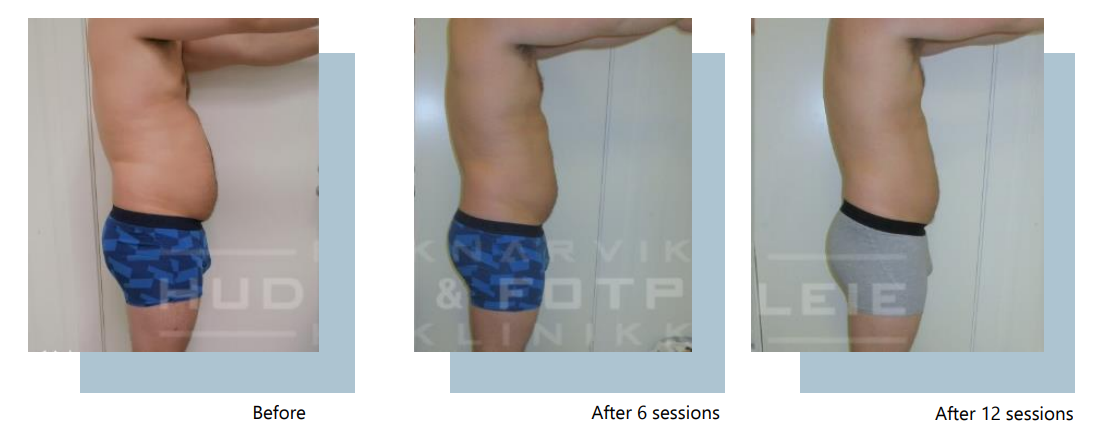 Body Sculptor - Institut Zenaura Bron